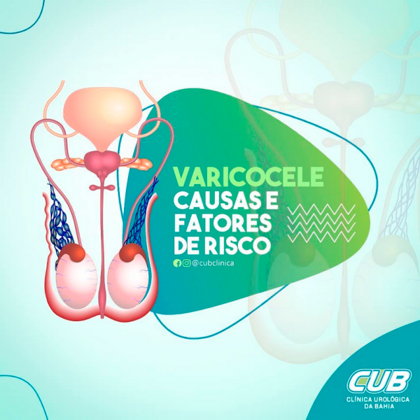 Varicocele – causas e fatores de risco – CUB – Clínica Urológica da ...