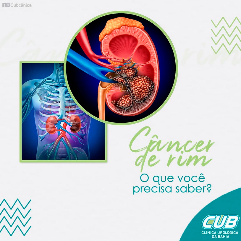 Câncer de rim. O que você precisa saber? - CUB - Clínica Urológica da ...